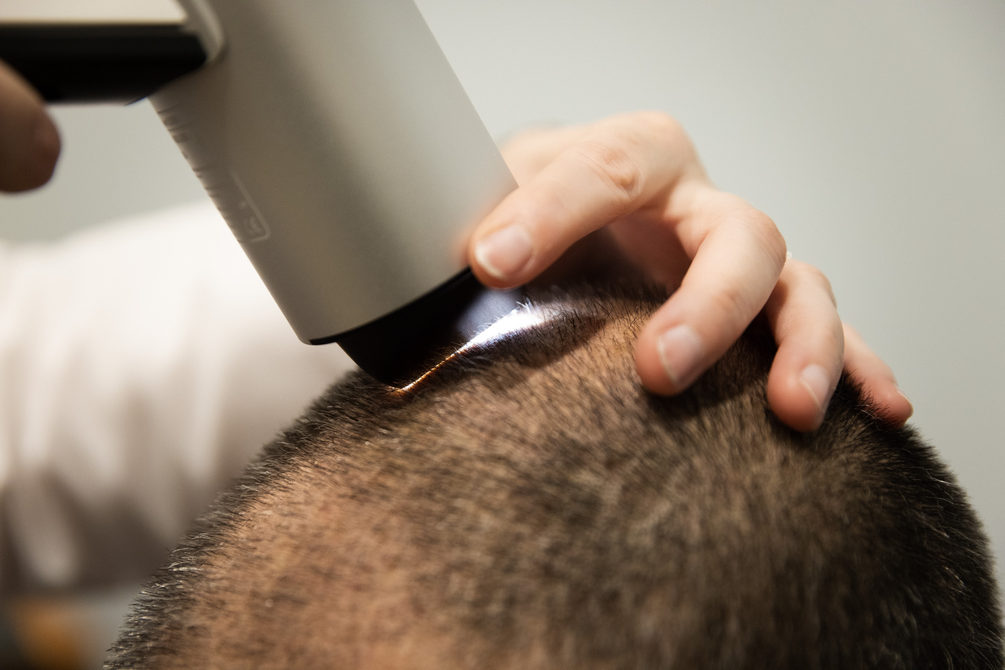 Hair Transplant in Rochester New York | Envision Eye & Aesthetics